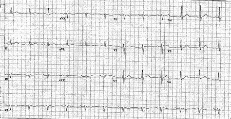 Dr Smiths Ecg Blog A Man In His 70s With Weakness And Syncope