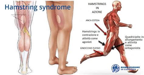La Hamstring Syndrome Riabilitazione In Campania