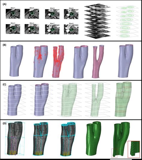 A Delineation Of Vessel From T Weighted Mri Images And Creation Of