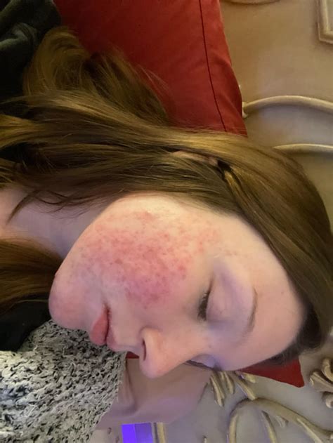 Accutane Journey Raccutane