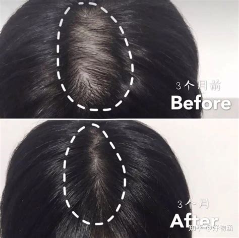 防脱发生发洗发水哪个牌子好 这款你用了吗 知乎