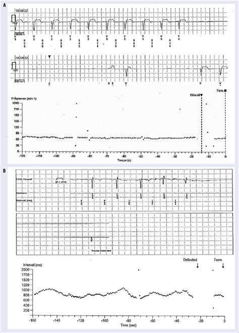 electrocardiogram recordings and corresponding rr interval plots a