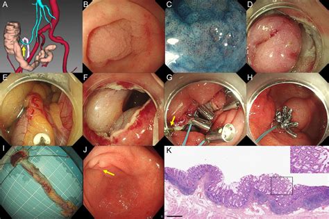 Transcolonic Endoscopic Appendectomy A Novel Natural Orifice