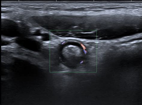 Bowel Ultrasound Bird Ultrasound