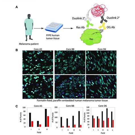 A Workflow For Analysis Of Patient Tumor Samples On A Tissue Array