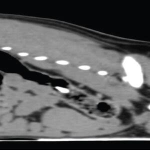 Postcontrast Computed Tomography Scan Images Using The Soft Tissue