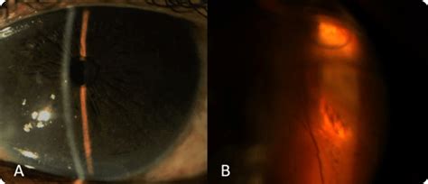 images showing shallow ac a and peripheral choroidal detachment b