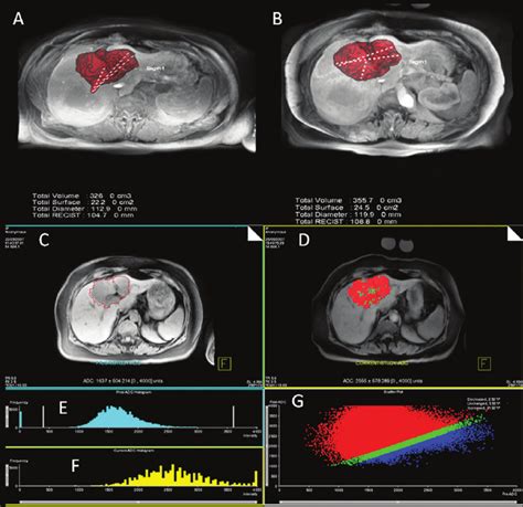 Images In 68 Year Old Woman With Cholangiocarcinoma Treated By Using Download Scientific