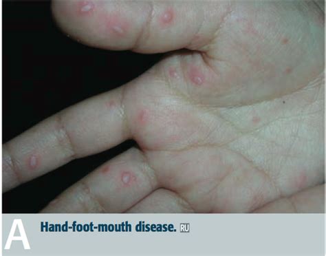 Maculopapular Rash Hands