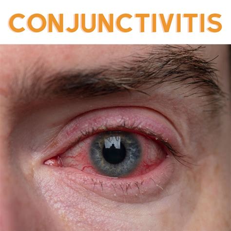 Conjunctivitis Eyecare Hygienematters Eyecareawareness Varsha