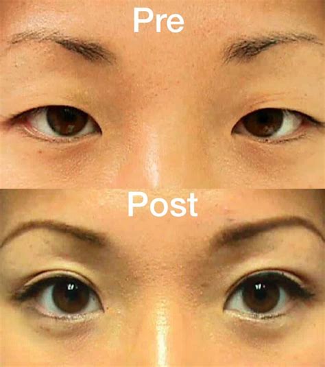 Blepharoplasty Asian Eyes Asian Upper Blepharoplasty With The Hinge