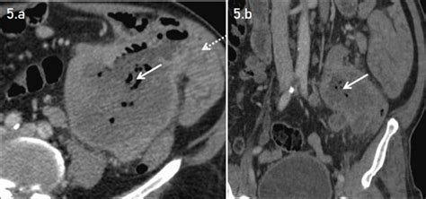 A And B 37 Year Old Case With Benign Duodenal Gist Axial A And