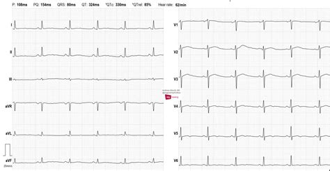 Long Qt Syndrome Look Closely And Do Not Trust The Ecg Computer Ecg