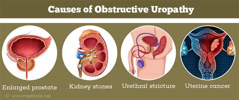 Obstructive Uropathy Causes Symptoms Diagnosis Treatment And Prevention
