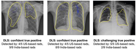 Le deep learning comme outil de dépistage de la tuberculose dans les