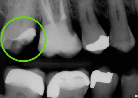 Deep Margin Elevation An Overview Clinical Research Dental
