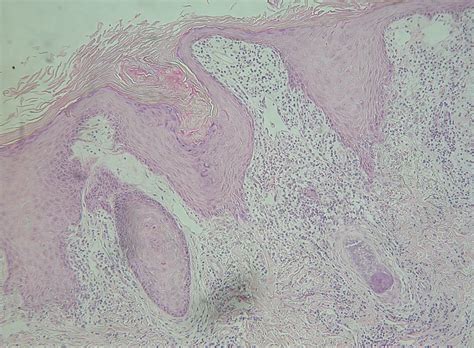 Scalp Biopsy And Diagnosis Of Common Hair Loss Problems Intechopen