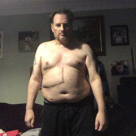 My Scar From Cancer On My Liver Operation R Scars