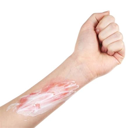 Premium Photo Treatment Of Burns On Female Hand Isolated On White