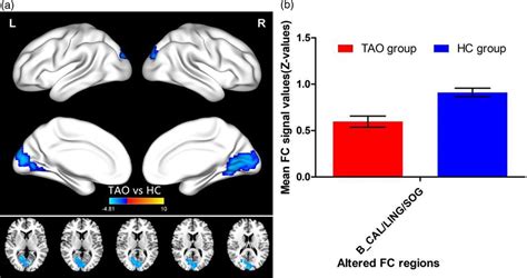 Altered Functional Connectivity Strength Of Primary Visual C
