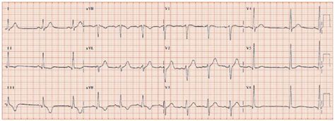 Sinus Node Disease Thoracic Key