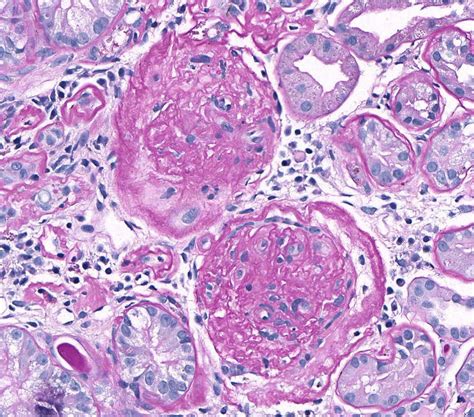 Global Glomerulosclerosis