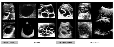 Hydatid Cyst Management And Follow Up In Cancer Patient Advance