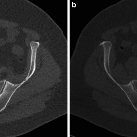 Solitary Bone Metastasis In The Left Iliac Bone Arrow Of A