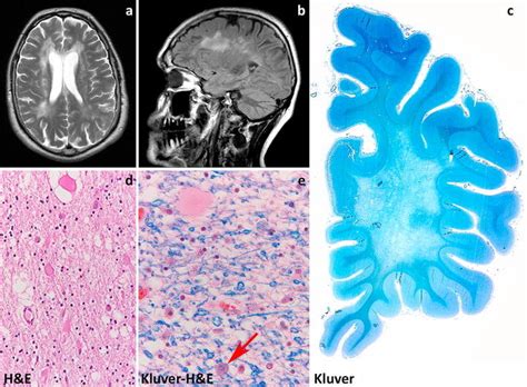 Hereditary Diffuse Leukoencephalopathy With Axonal Spheroids A