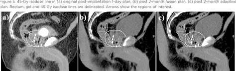 Figure 5 From Peg Spacer Gel And Adaptive Planning Vs Single Plan In