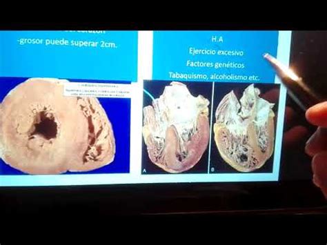 Tipos De Cardiopatías TIPOSDE