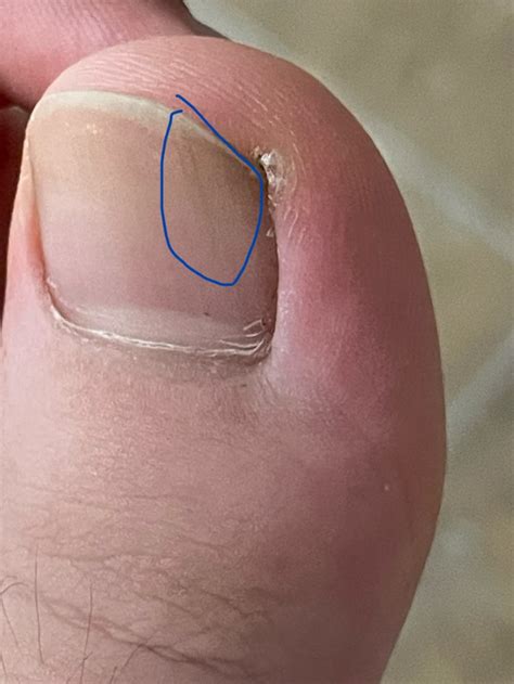 발톱에 검은색 줄이 있어요 지식in