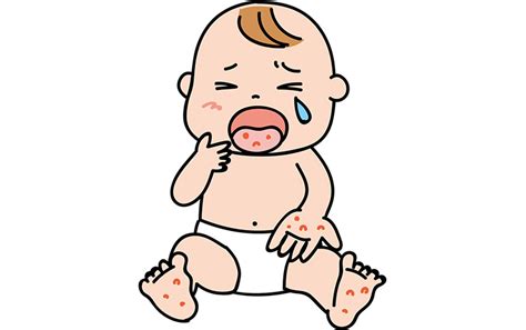 夏に流行する病気「手足口病」をご存知ですか？ 皮膚科医の教えるお肌のブログ ～自分らしいお肌で生きよう「わたしの皮膚治療」ブログ～
