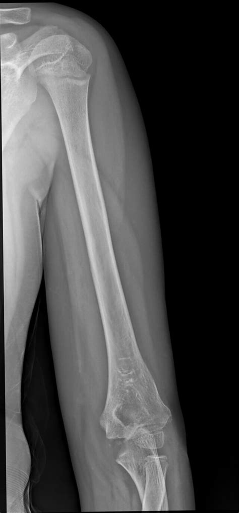 Radiopaedia Case Trochlear Ossification Normal Fragmented Appearance