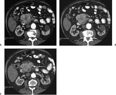 40 Acinar Cell Carcinoma Of The Pancreas Radiology Key