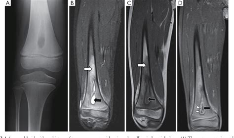 Osteomyelitis Semantic Scholar