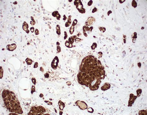 Pathology Outlines Microglandular Adenosis