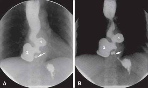 Epiphrenic Diverticulum