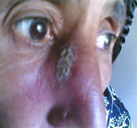 Typical Infiltrated Erythematous Plaque With Crusting Download