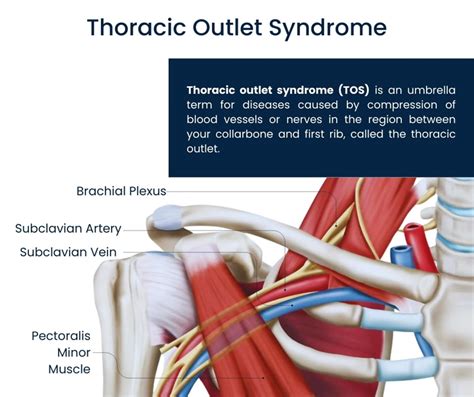 8 Best Thoracic Outlet Syndrome Artofit