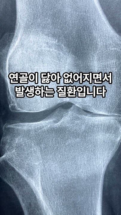 퇴행성관절염 수술하기전 고려해봐야 할 비수술적인 치료방법 퇴행성관절염 관절염치료 프롤로주사 Youtube