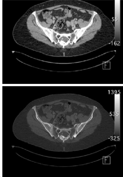 Computed Tomography Ct Scan Of The Lumbosacral Spine Demonstrating