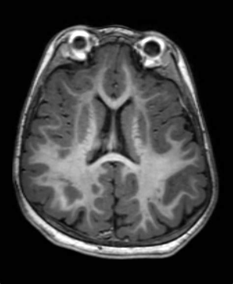 Pituitary Adenoma Radiology Case Radiology Mri
