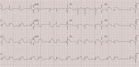 Cardiac Arrest Ventricular Fibrillation Inferior And Right
