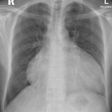 Echocardiogram At Admission Showing Pericardial Effusion Pe A Download Scientific Diagram
