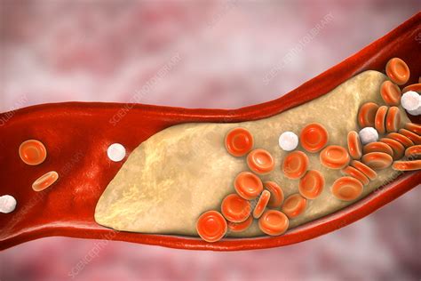 Atheromatous Plaque In Artery Illustration Stock Image F020 9978