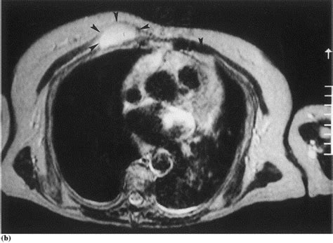 Magnetic Resonance Imaging Of Pyomyositis In 43 Cases European