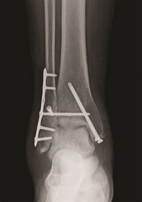 Current Insights On Fixation Options For Ankle Syndesmosis Injuries