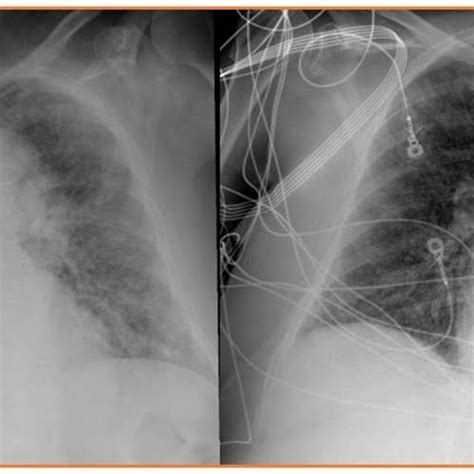 Chest X Ray Showing Diffuse Bilateral Infiltrates At Presentation Download Scientific Diagram