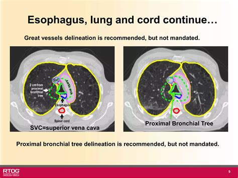 Rtog 1106 Oar Atlas Thoracic Radiation Therapy Ppt